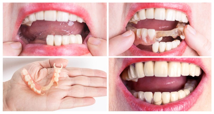Dentures Before And After Pictures | What To Expect