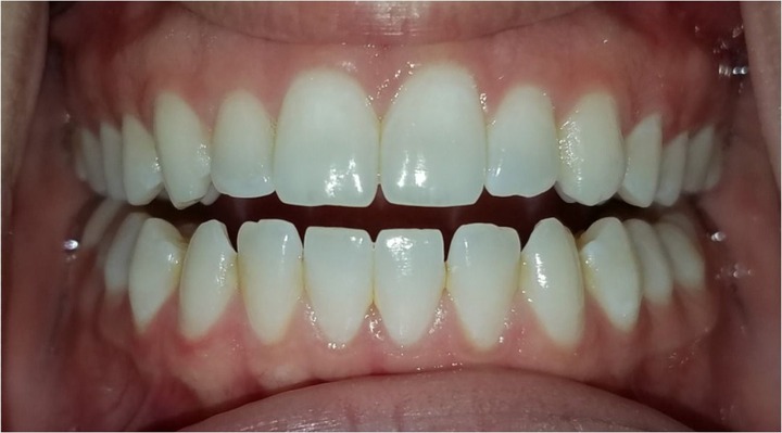 Overcoming Open Bite: 4 Types, Causes & Treatment Options