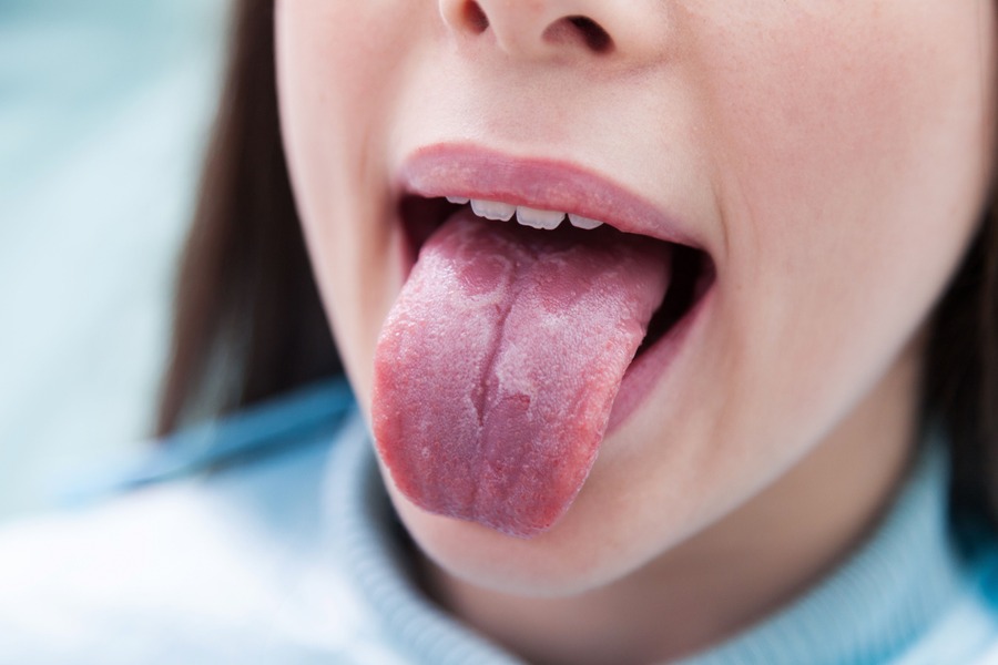 8 Reasons for Geographic Tongue & How To Treat It