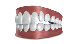 Overcoming Open Bite: 4 Types, Causes & Treatment Options