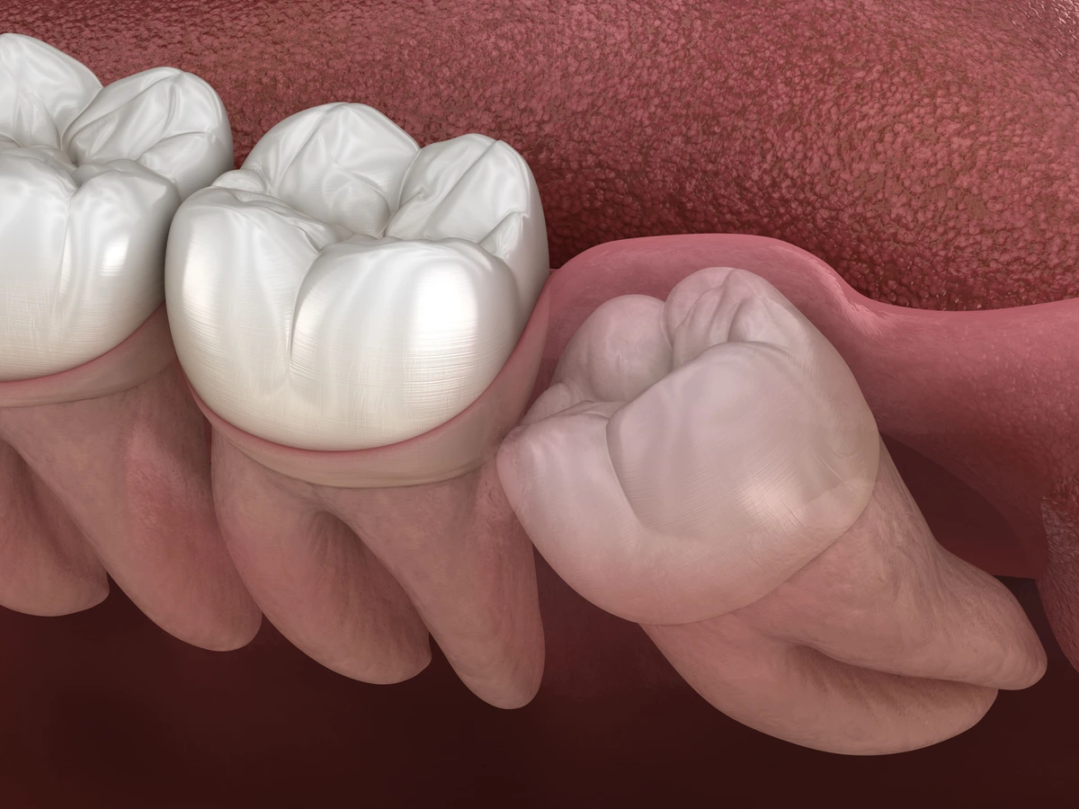 8 Warning Signs for Impacted Wisdom Teeth & 4 Impaction Type